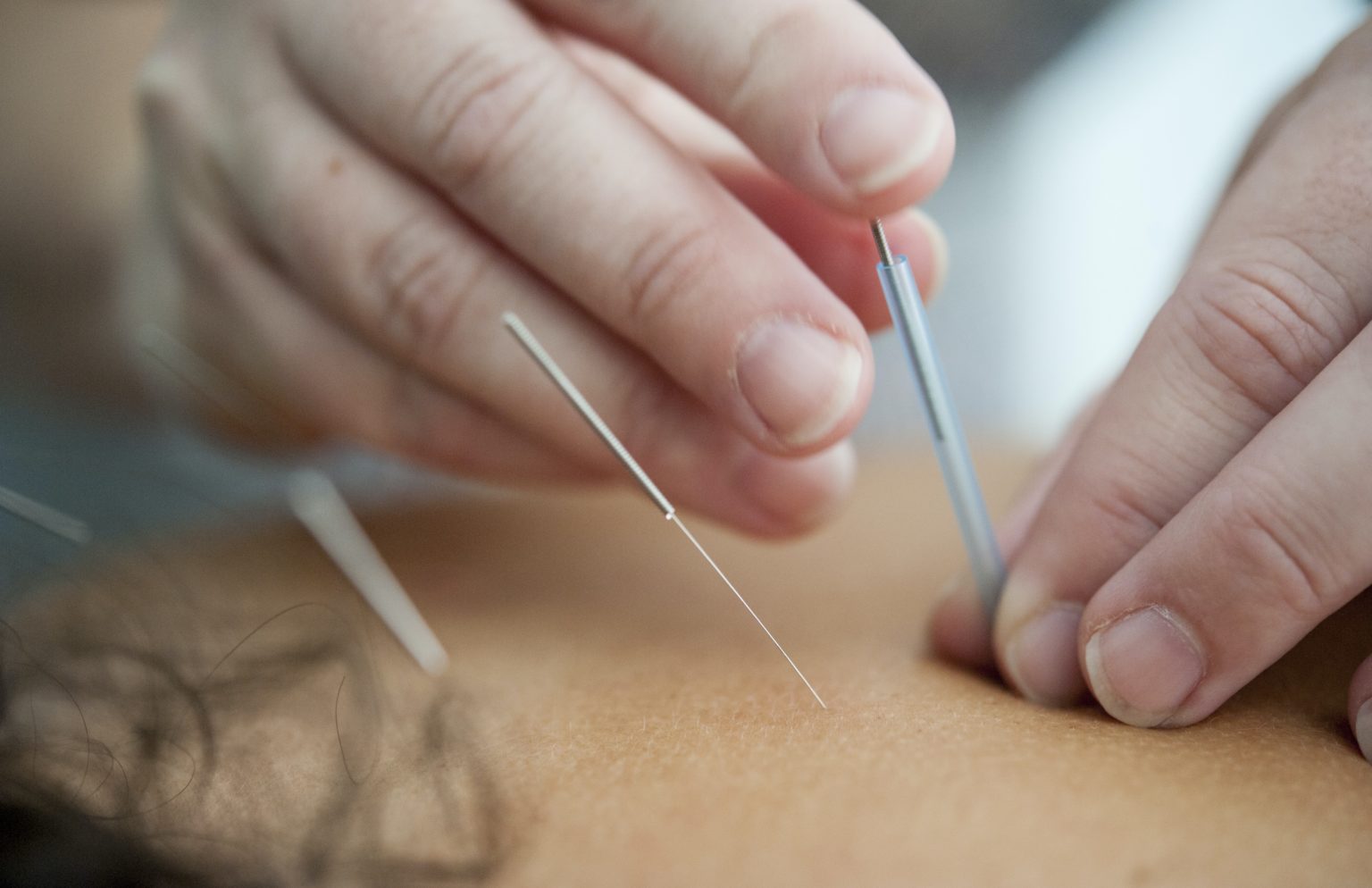 What Is Acupuncture?